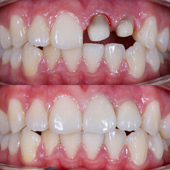 Tooth Crown Before and After: Stunning Transformations